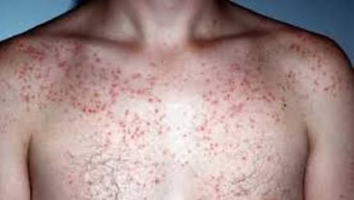 How to Get Rid of Chest Acne?