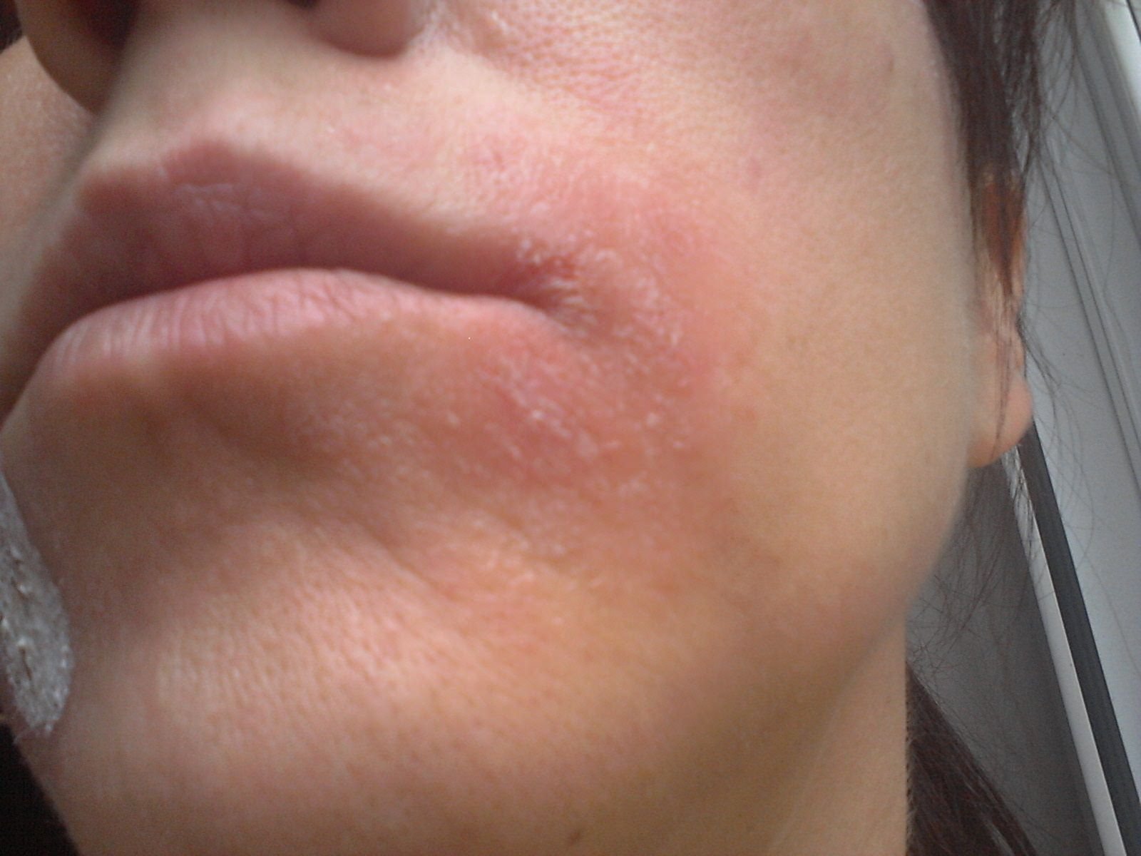 How To Treat Eczema Naturally How To Treat Eczema Naturally