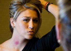 How to Get Rid of Hickies?