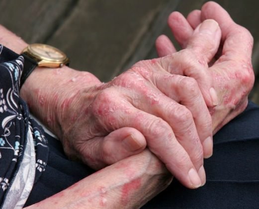 How to Get Rid of Rash? (Naturally & Fast)